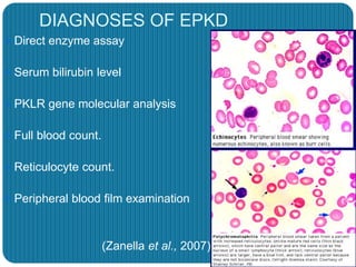 ERYTHROCYTIC PYRUVATE KINASE DEFICIENCY: HAEMATOLOGICAL IMPLICATIONS | PPTX