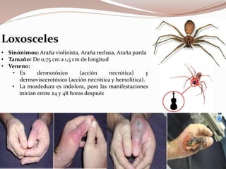 Mordedura De Araña Reclusa Parda Etapa 1