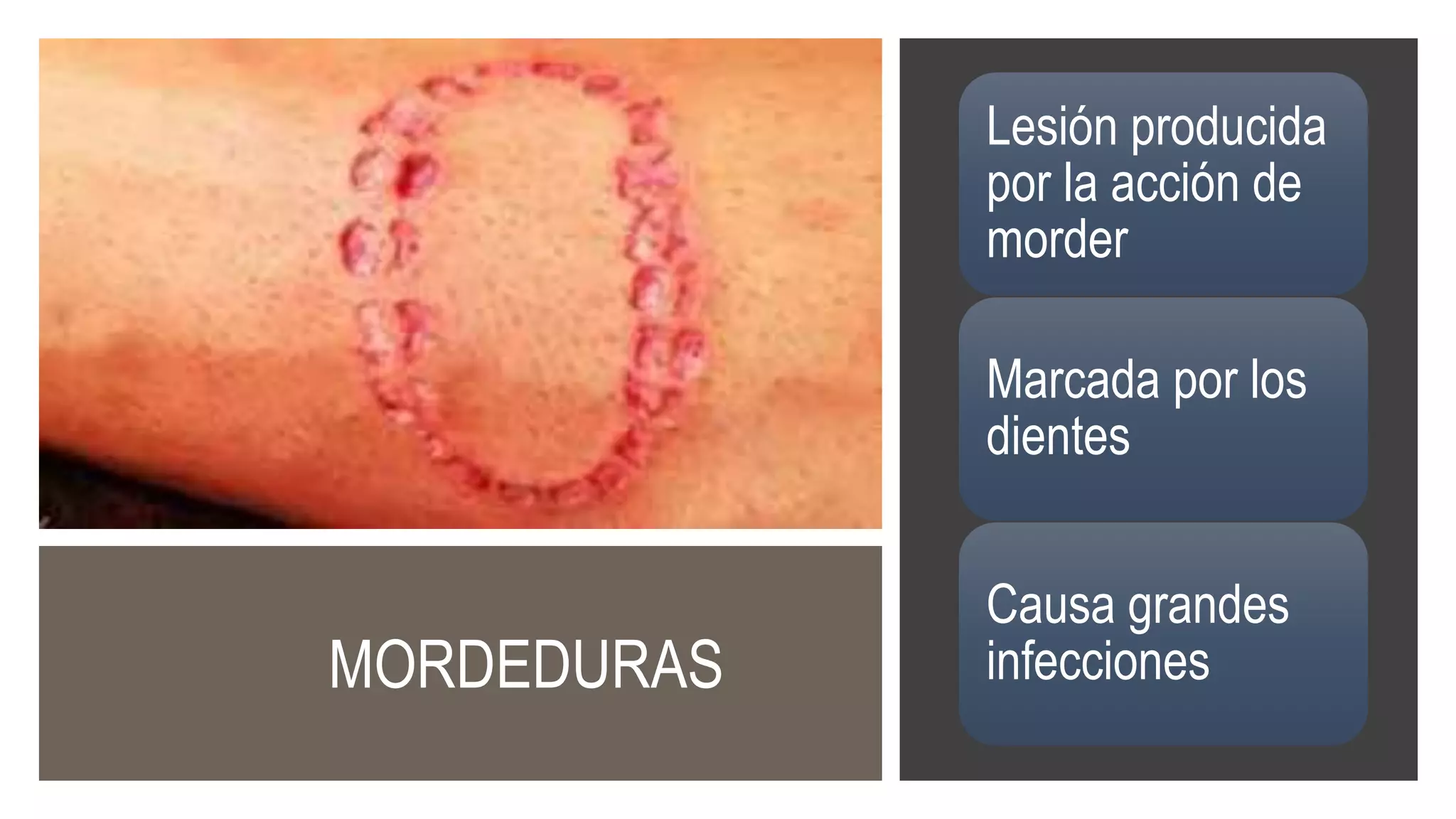 Mordeduras y picaduras | PPTX