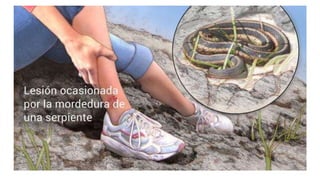 Mordeduras y picaduras | PPTX