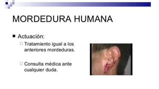 Mordeduras y picaduras | PPTX