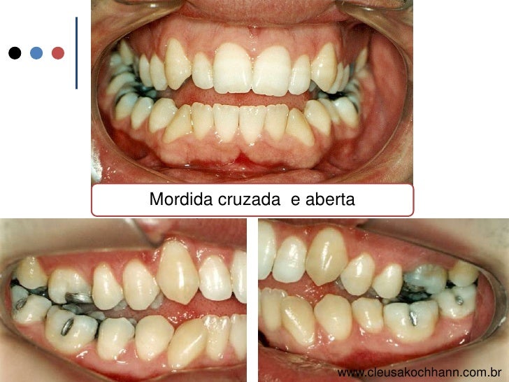 Mordida Aberta Mordida Cruzada