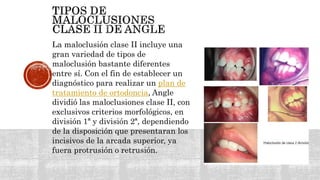 Maloclusión clase II | PPTX