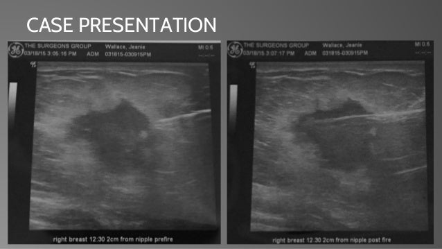 More Than Throwing Knives: Ultrasound Guided Breast Biopsy 2015