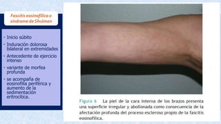 Morfea- esclerodermia localizada | PPTX