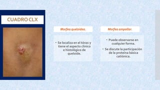 Morfea- esclerodermia localizada | PPTX