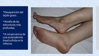 Morfea- esclerodermia localizada | PPTX