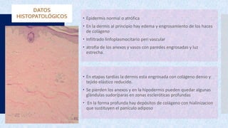Morfea- esclerodermia localizada | PPTX