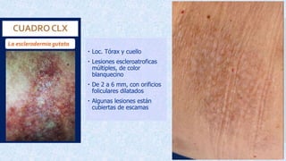 Morfea- esclerodermia localizada | PPTX