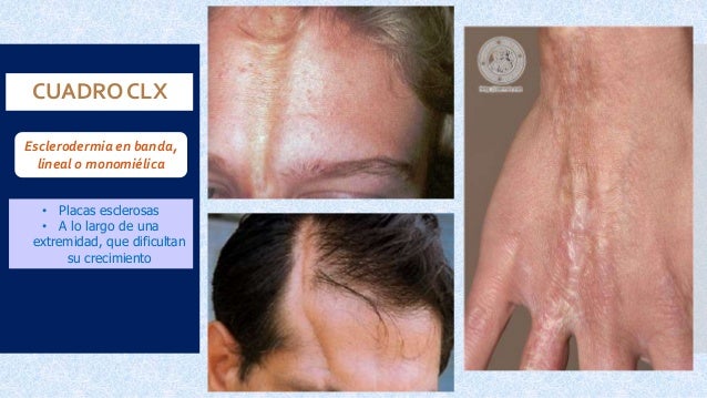 Morfea- esclerodermia localizada