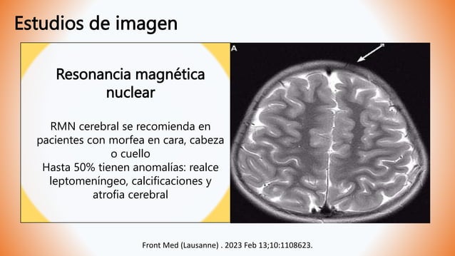 Morfea (Esclerosis Cutánea Localizada) | PPT
