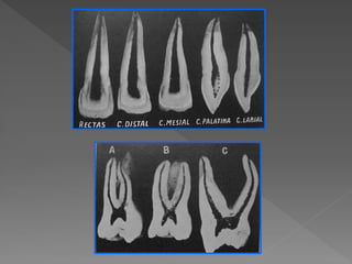 Morfologia de cavidades_pulpares(2) | PDF