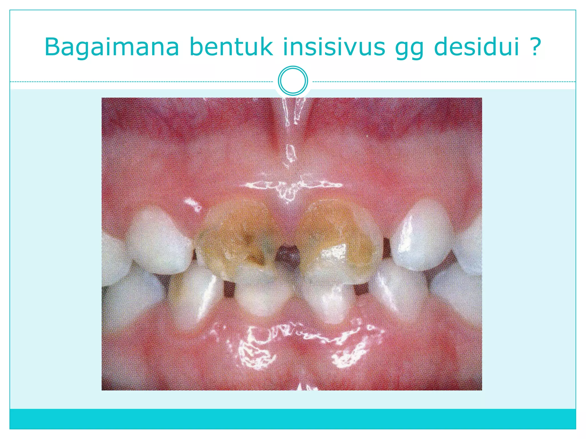 Morfologi Gigi Desidui.pdf