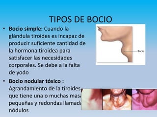 Enfermedades del Sitema Endocrino | PPTX