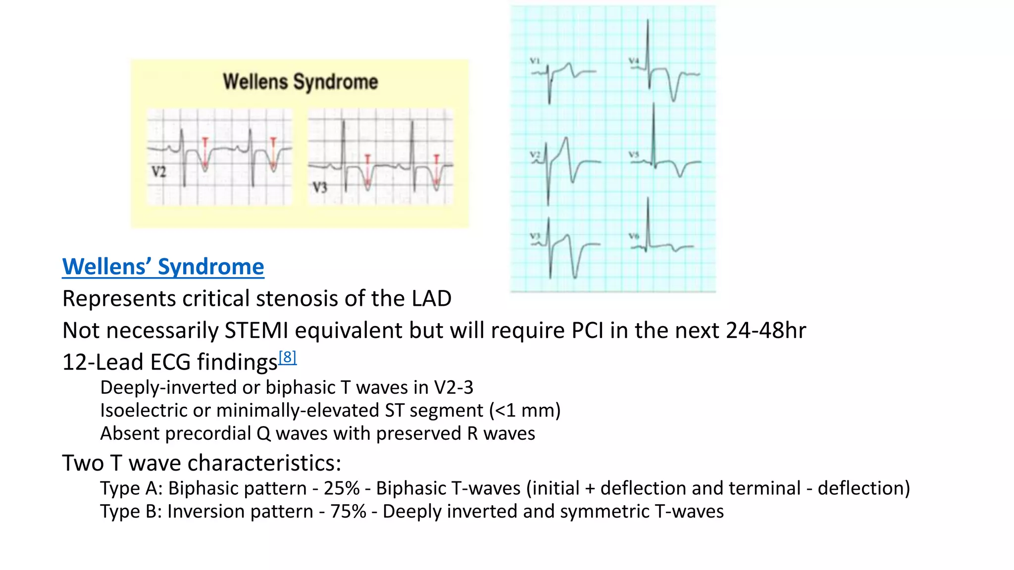 STEMI Equivalent | PPTX