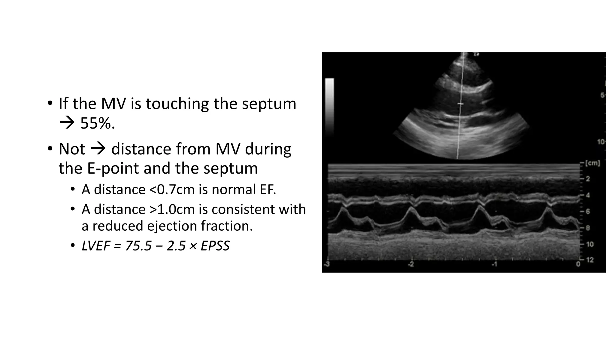 STEMI Equivalent | PPTX