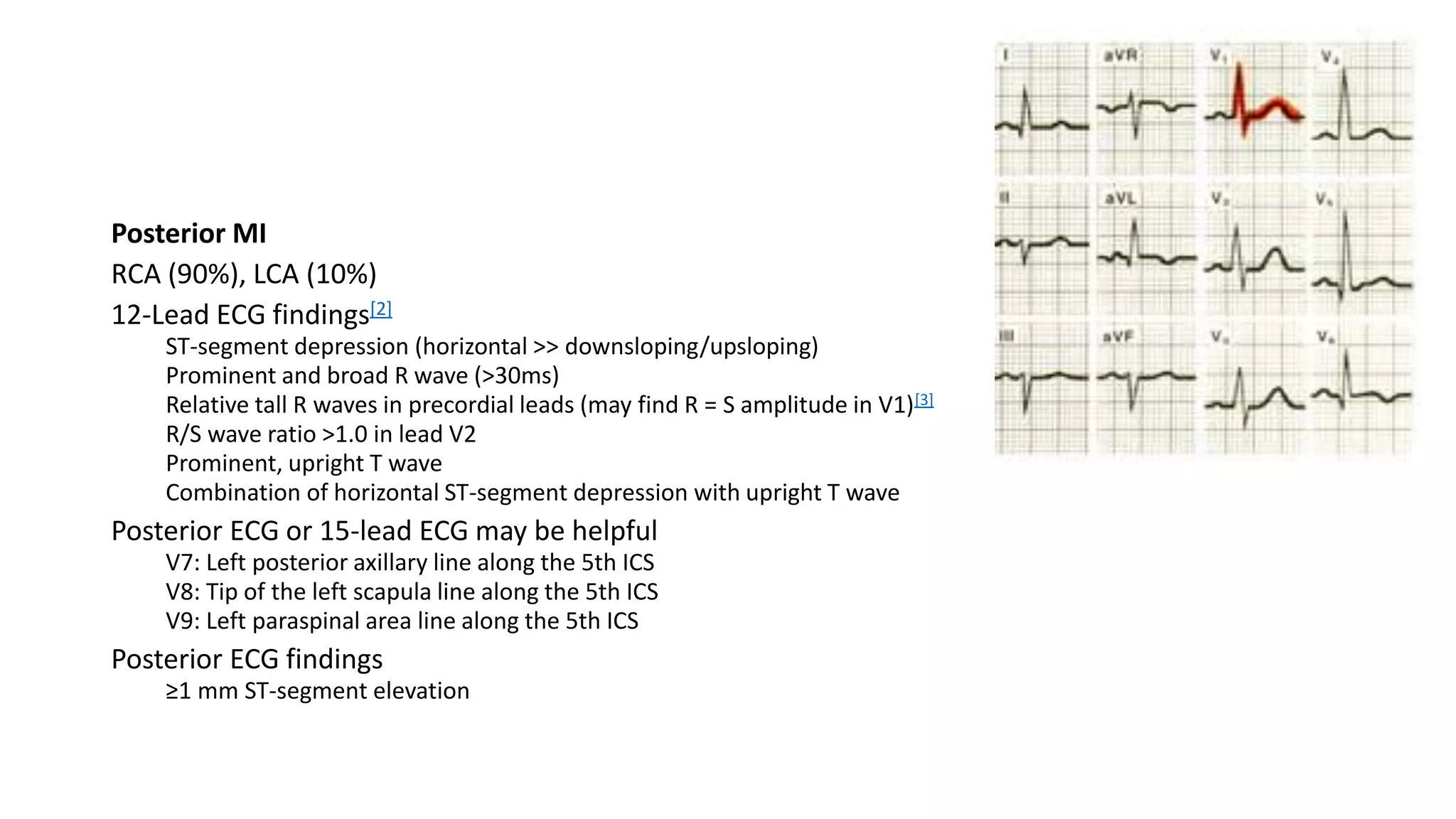 STEMI Equivalent | PPTX