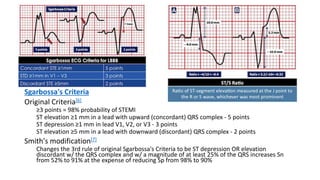 STEMI Equivalent | PPTX