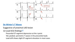 STEMI Equivalent | PPTX