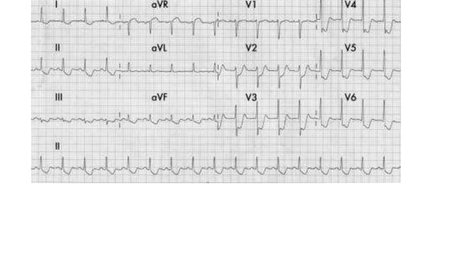 STEMI Equivalent | PPTX | Heart and Cardiovascular Diseases | Diseases ...