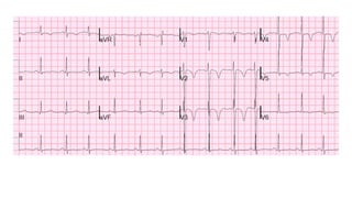 STEMI Equivalent | PPTX