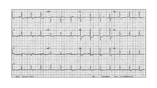What about this ST and T waves ( ECG sessions ) | PPTX