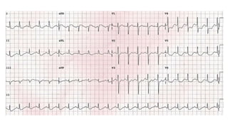 What about this ST and T waves ( ECG sessions ) | PPT