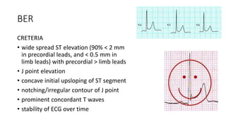 What about this ST and T waves ( ECG sessions ) | PPTX