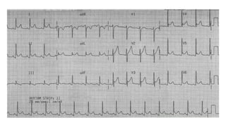 What about this ST and T waves ( ECG sessions ) | PPT