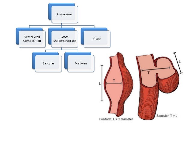 Coronary Artery Aneurysms and Ectasia