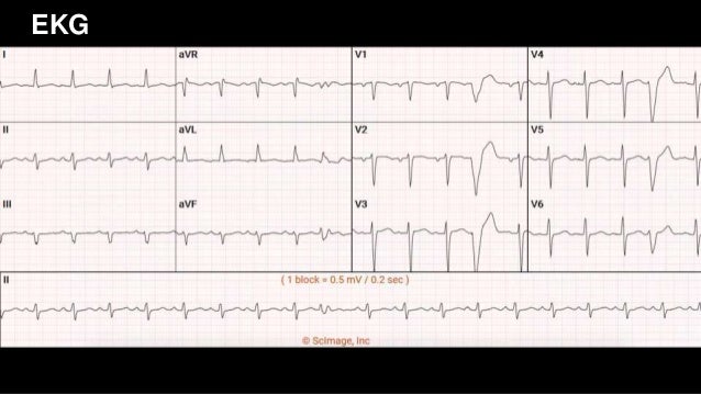 Heart Failure with Reduced Ejection Fraction