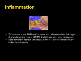 Ocular Chemical Burns - Pathophysiology and Evidence-Based Treatment | PPTX