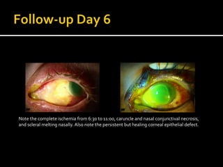 Ocular Chemical Burns - Pathophysiology and Evidence-Based Treatment | PPTX