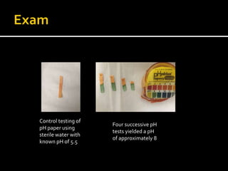 Ocular Chemical Burns - Pathophysiology and Evidence-Based Treatment | PPTX