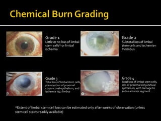 Ocular Chemical Burns - Pathophysiology and Evidence-Based Treatment | PPT