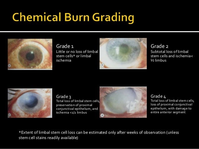 Ocular Chemical Burns - Pathophysiology and Evidence-Based Treatment