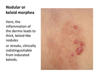 Morphea | PPT