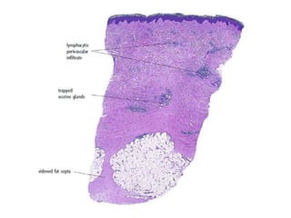 Morphea Histopathology