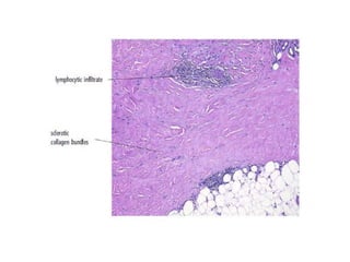 Morphea Histopathology