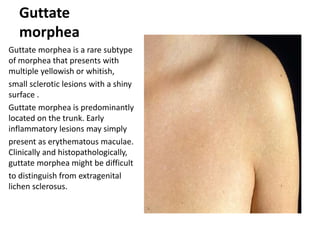 Morphea | PPT