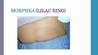 Morphea and allied Sclerosing Inflammatory Dermatoses-1.pptx