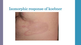 Morphea and allied Sclerosing Inflammatory Dermatoses-1.pptx