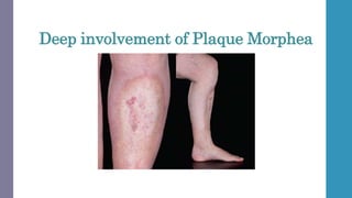 Morphea and allied Sclerosing Inflammatory Dermatoses-1.pptx