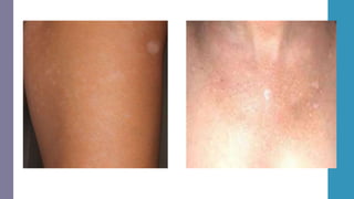 Morphea and allied Sclerosing Inflammatory Dermatoses-1.pptx
