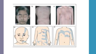 Morphea and allied Sclerosing Inflammatory Dermatoses-1.pptx
