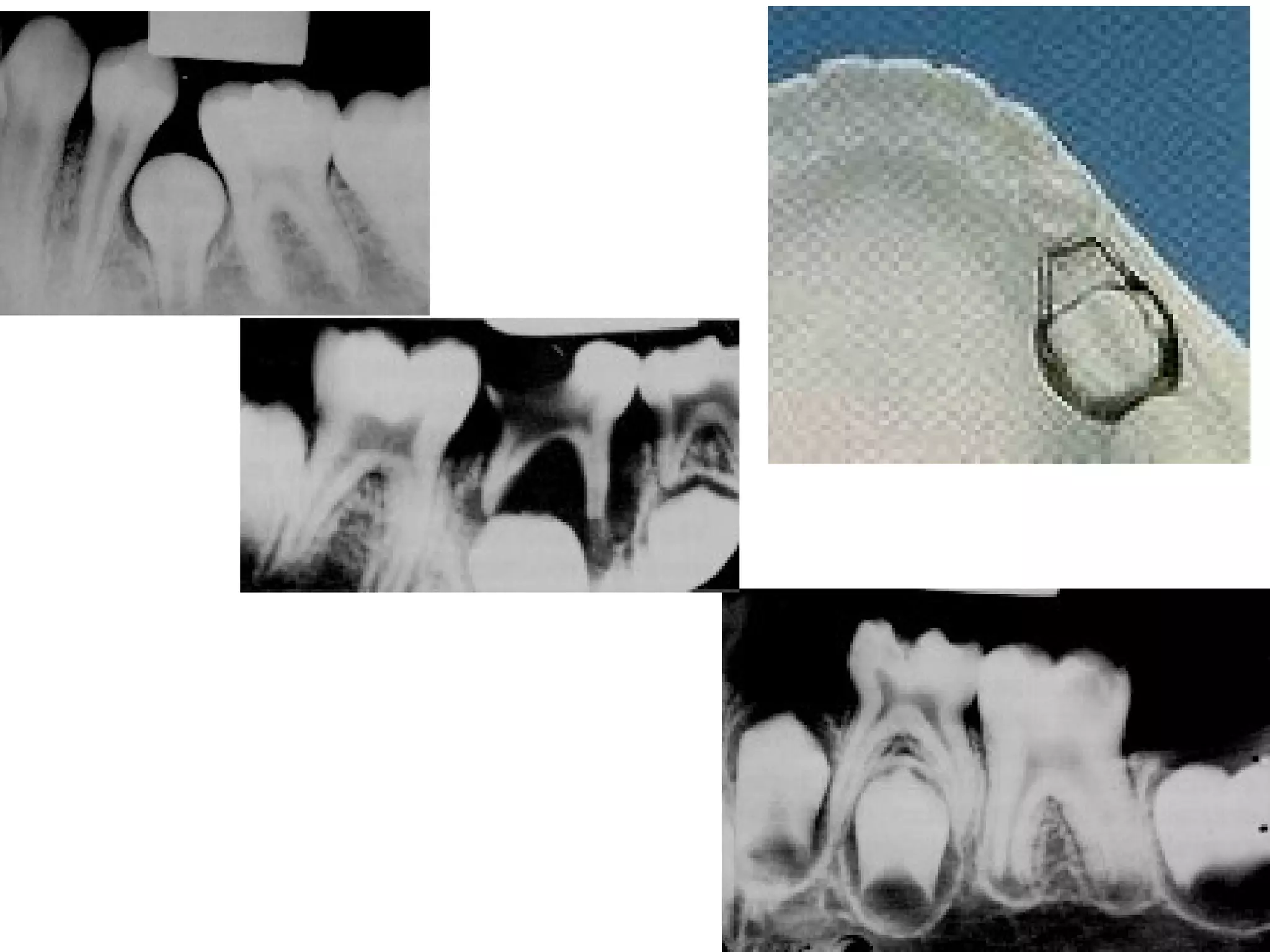 tooth Morphology central incisor | PPT
