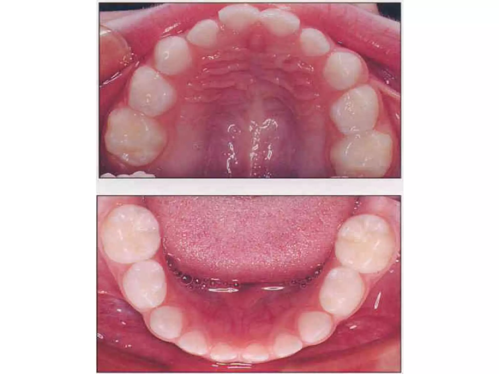 tooth Morphology central incisor | PPT