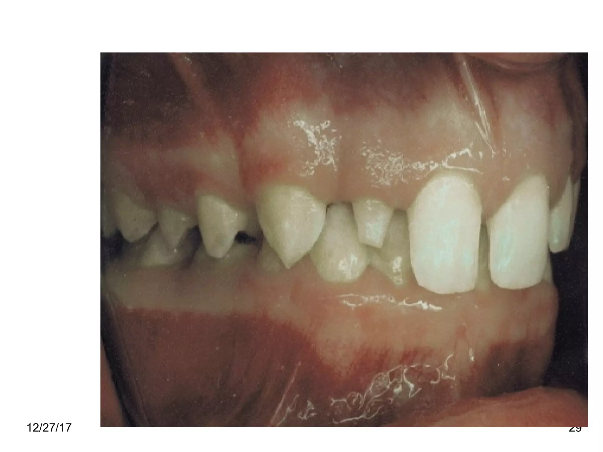 tooth Morphology central incisor | PPT