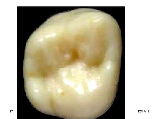 tooth Morphology central incisor | PPT