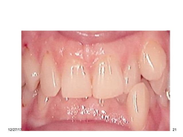tooth Morphology central incisor | PPT